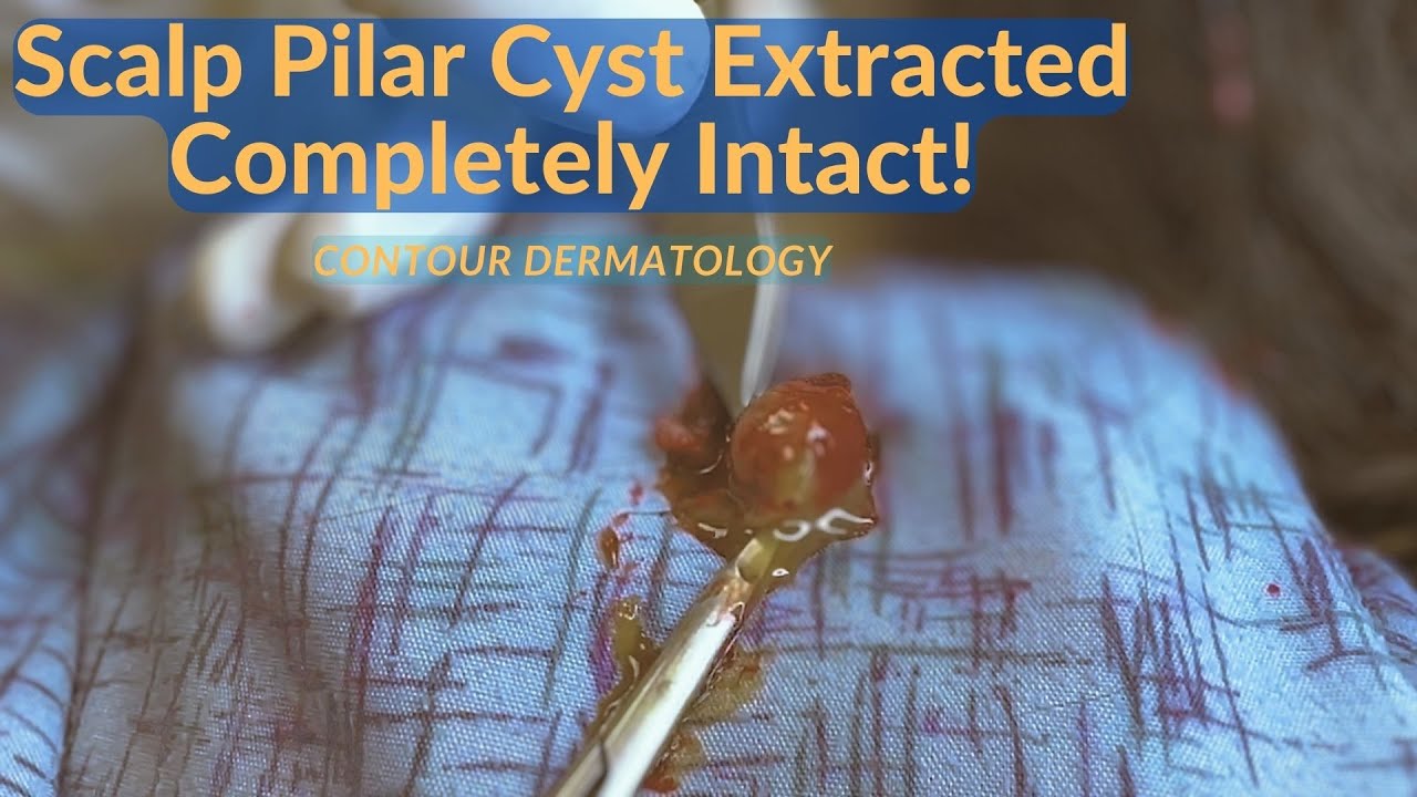 Scalp Pilar Cyst Removed In One Piece Contour Dermatology Youtube