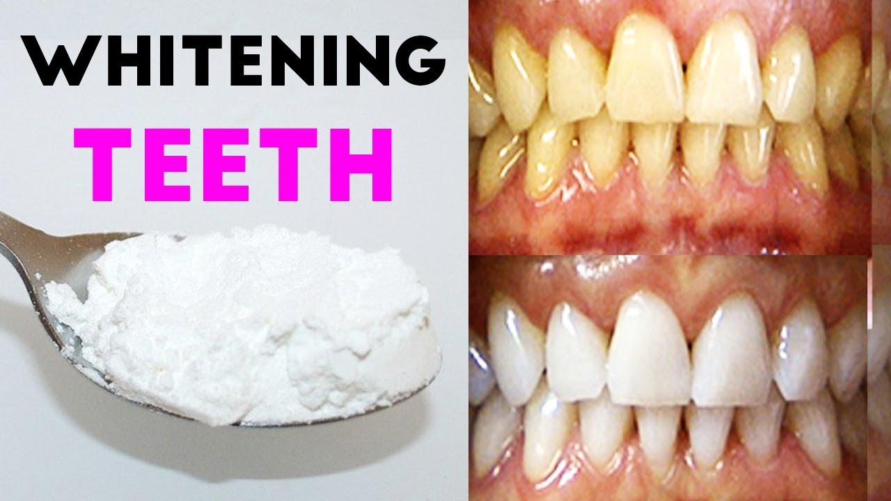 Teeth Whitening With Baking Soda How To Whiten Teeth Youtube