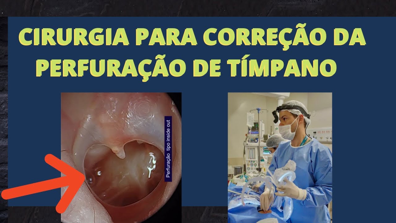 Tímpano Perfurado Tem Cura Retoedu