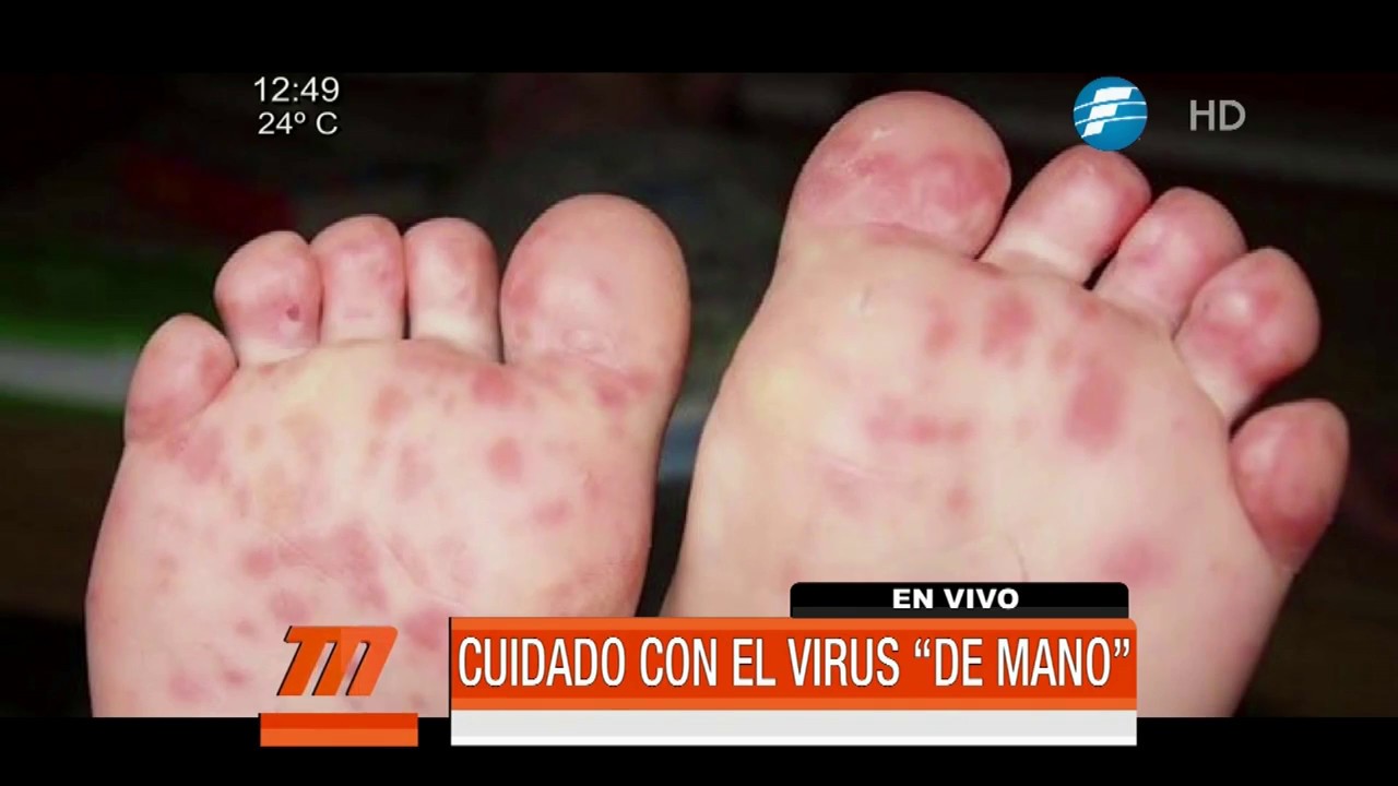 Puntos Rojos En Manos Y Pies