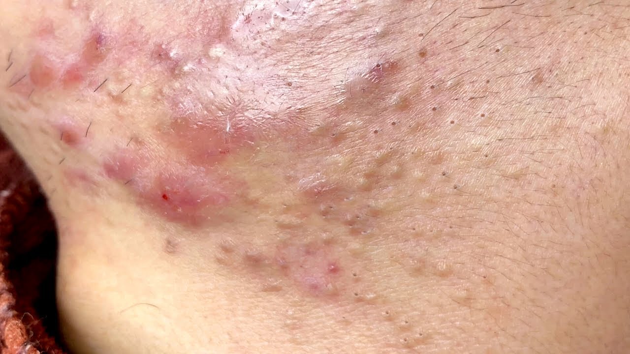 Relax With Massive Cystic Acne Popping Video