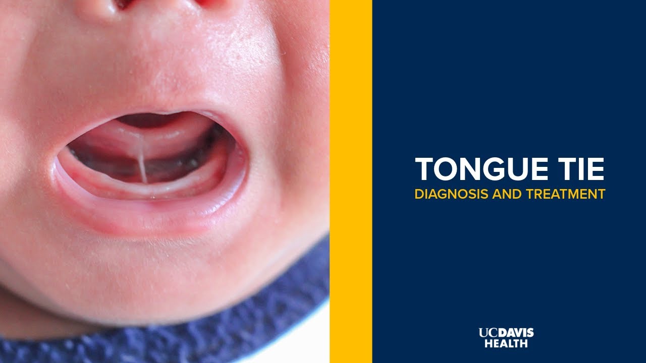 Tongue Tie Ankyloglossia Explained Symptoms Diagnosis Treatment