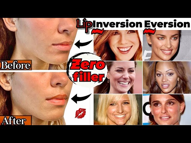 Botox For Lip Flip Cost Infoupdate Org