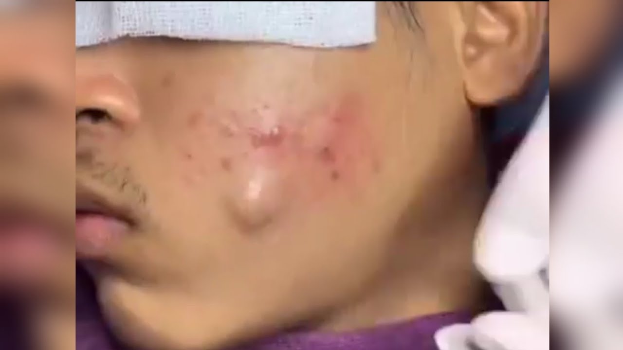 Big Giant Cyst Face Pimple Extraction Cyst Popping This Week