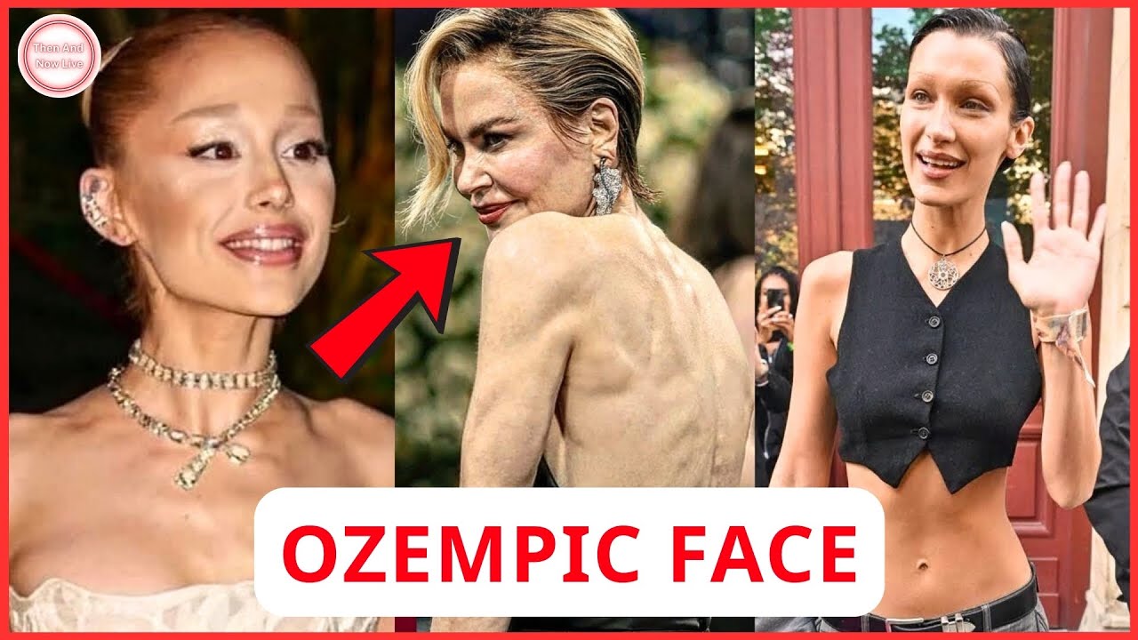 Top Celebs Suffering From Ozempic Face Before And After Photos Then
