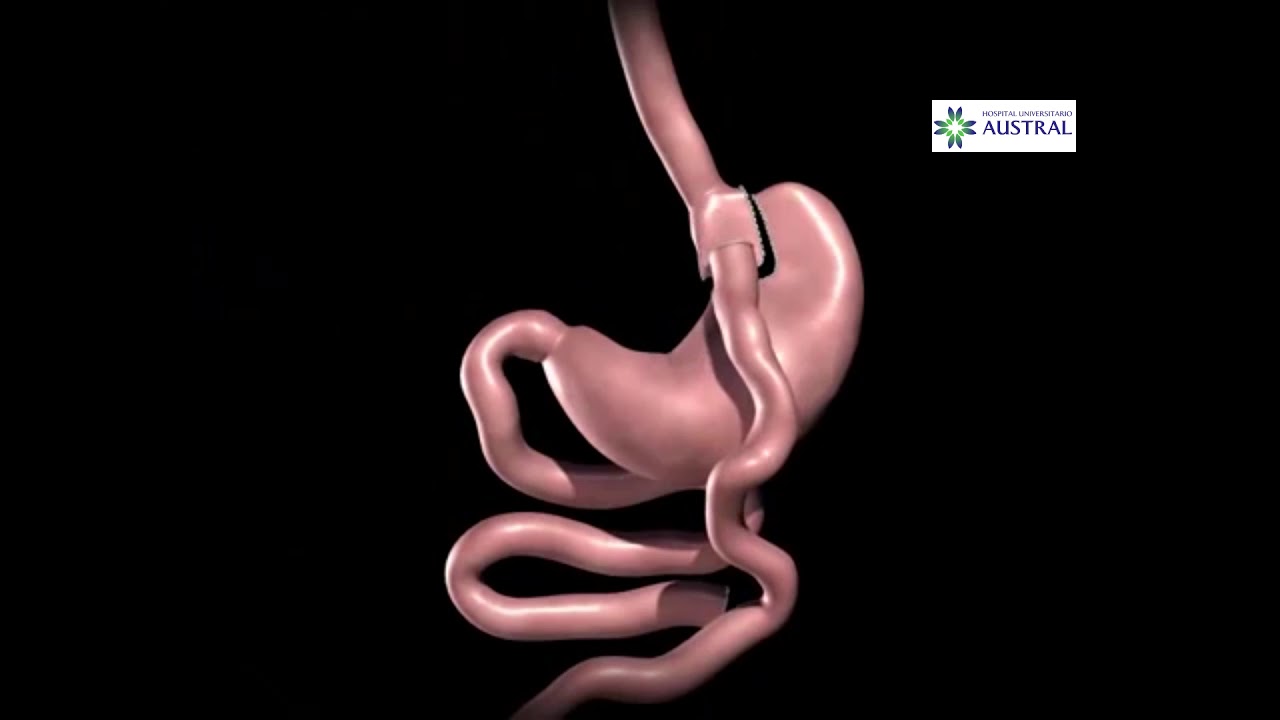 Bypass Gástrico En Y De Roux Laparoscopico Youtube