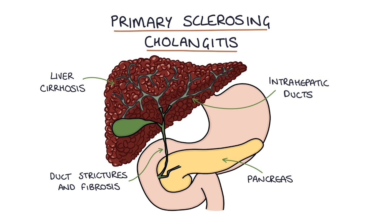 Sclerosing Cholangitis