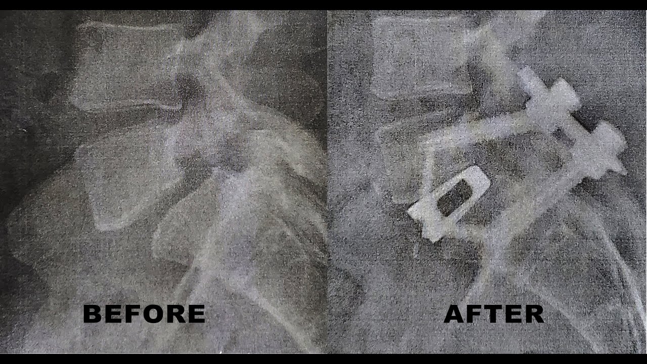 Weaning Off Back Brace After Spinal Fusion At Lisa Mccoy Blog