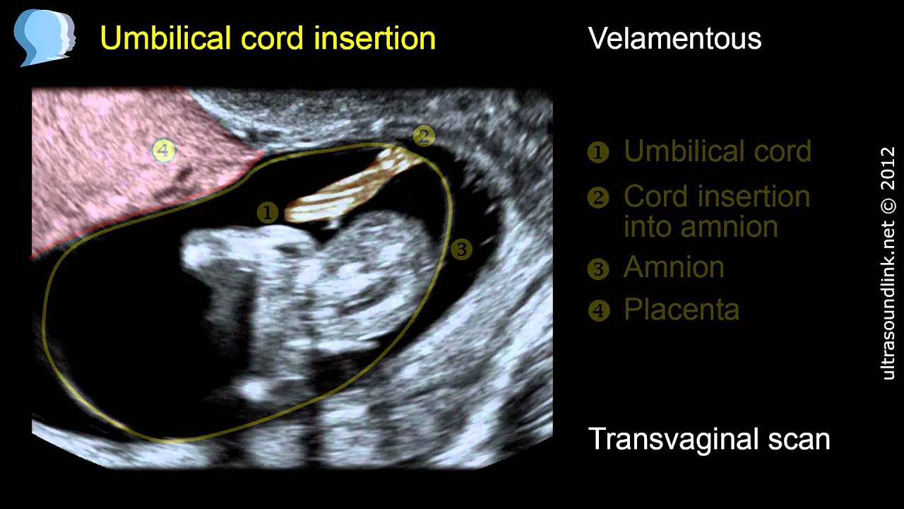 Velamentous Cord Insertion Ultrasound