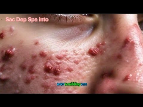 Sac Dep Spa Big Deep Blackheads Sac Dep Spa Pimple Popping This Week