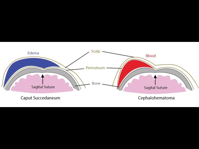Caput Succedaneum Vs Cephalohematoma Why Does My Baby S Head Look