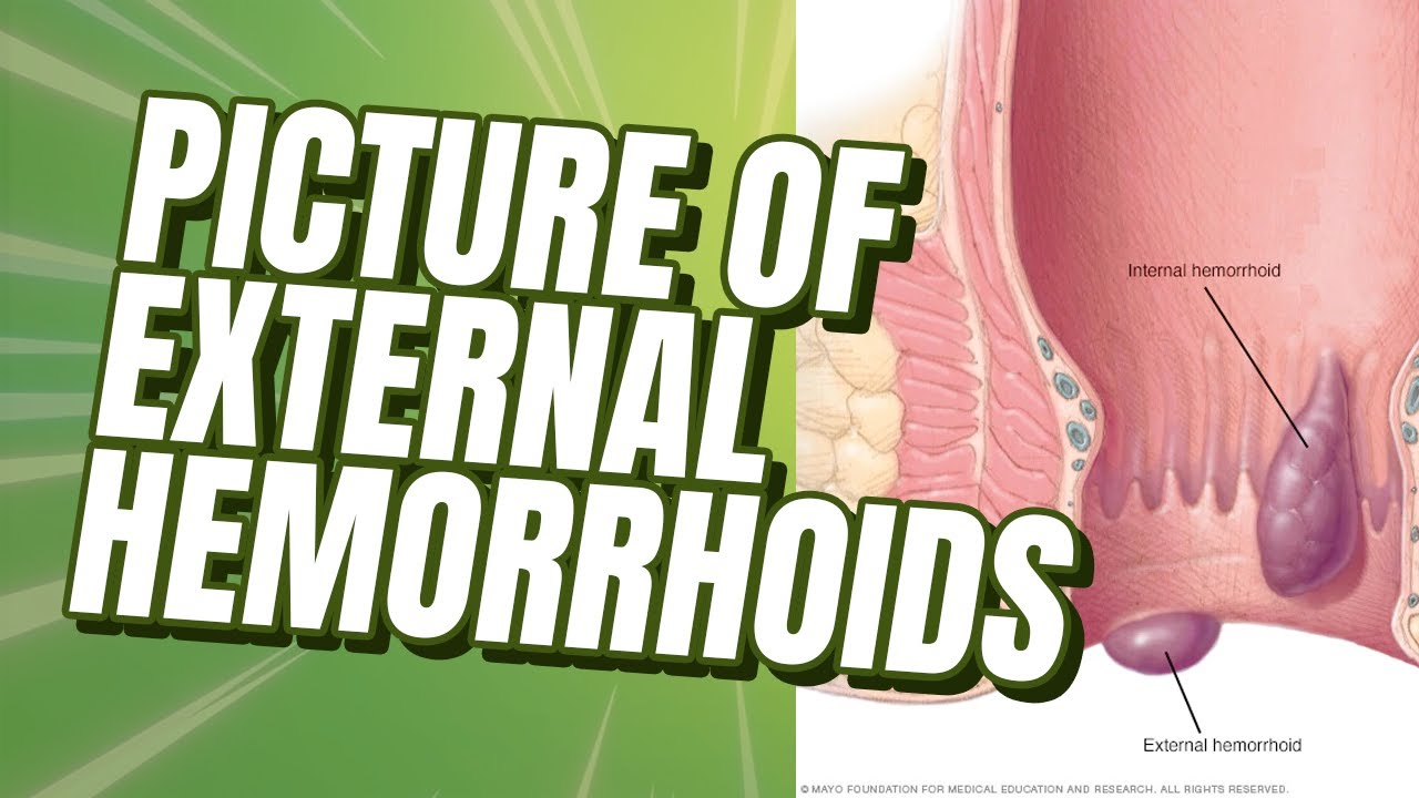 Picture Of External Hemorrhoid External Hemorrhoids Hem Healer