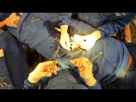 Cura Cirúrgica De Hidrocele Em São João Youtube
