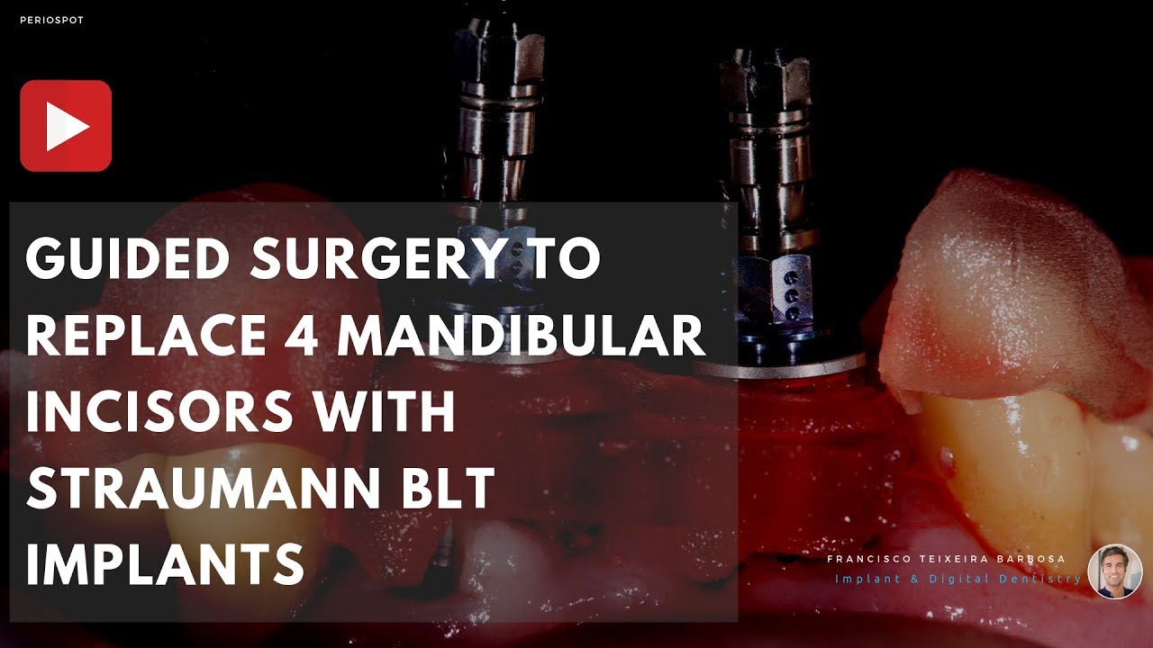 Guided Surgery With Straumann Blt Youtube