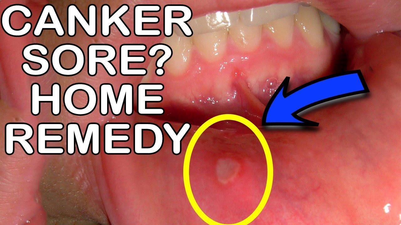How To Get Rid Of Canker Sores Mouth Ulcer Home Remedy Youtube