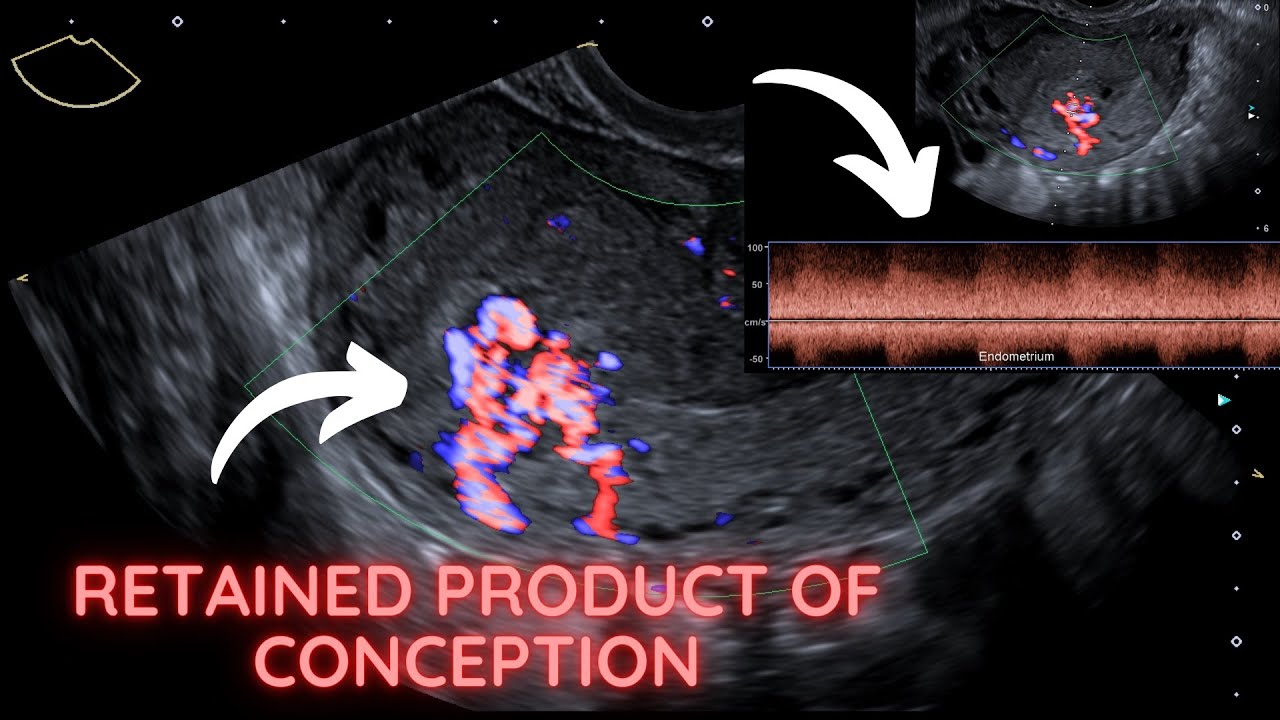 What Do Retained Products Of Conception Look Like At Linda Weaver Blog