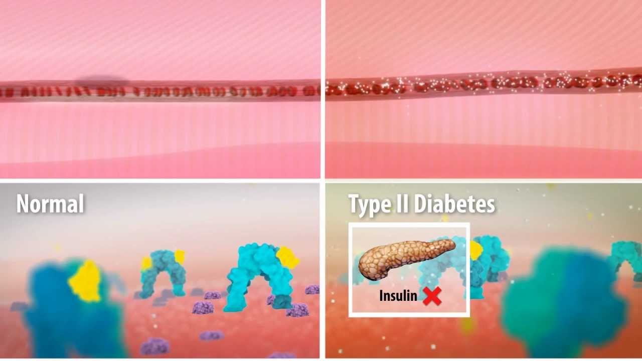 Insulin Resistance In Type 2 Diabetes Youtube