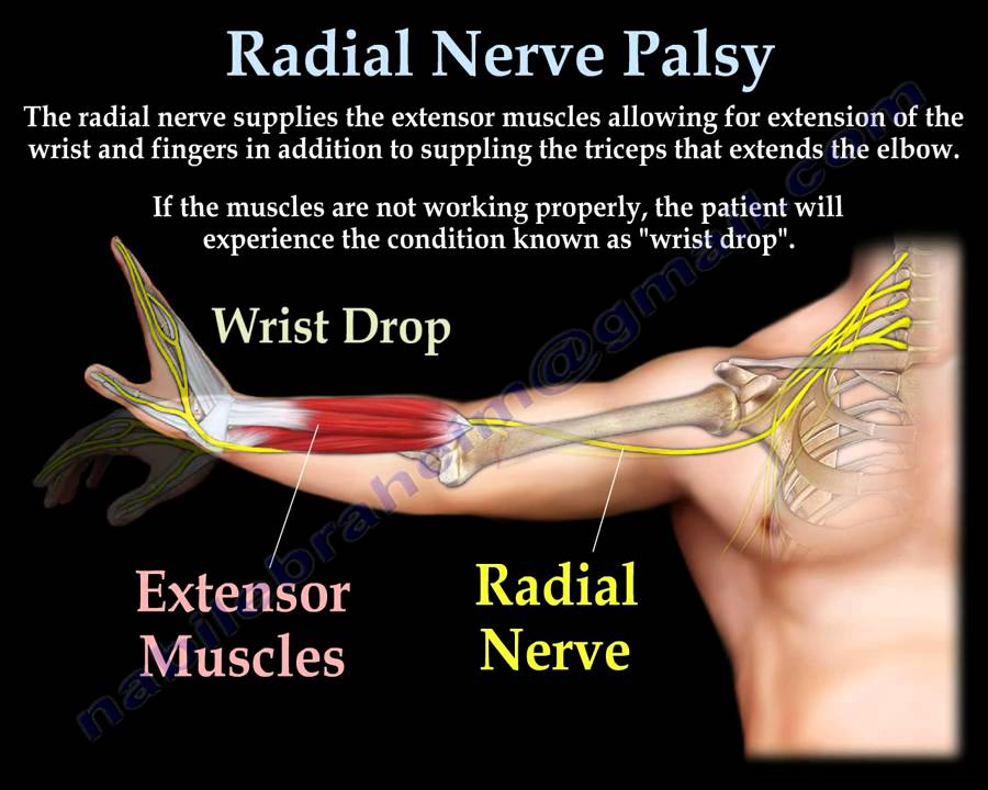 Radial Nerve Palsy Injury Wrist Drop Everything You Need To Know
