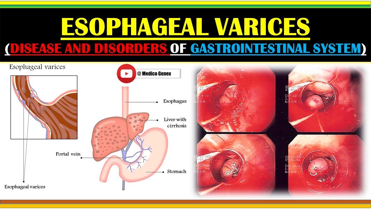 Esophageal Varices History And Physical At Ricardo Lafayette Blog