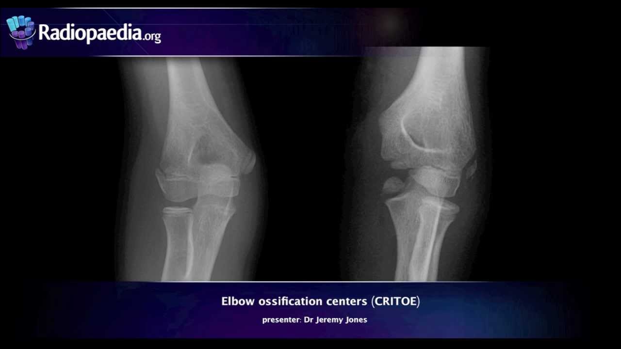 Elbow Ossification Centers Critoe Radiology Video Tutorial Youtube