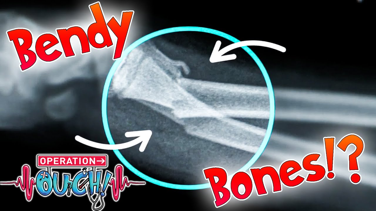 Bendy Bones рџ ґ Full Episodes Operation Ouch Youtube