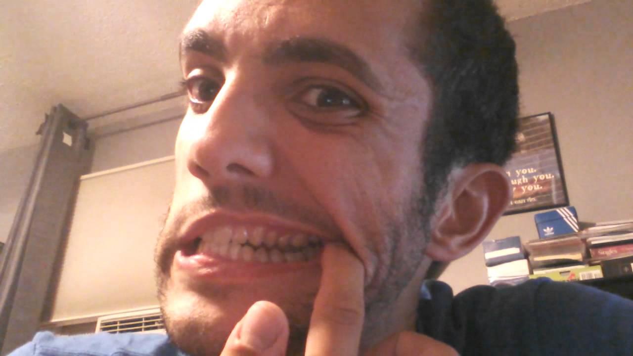 Dislocated Jaw Youtube