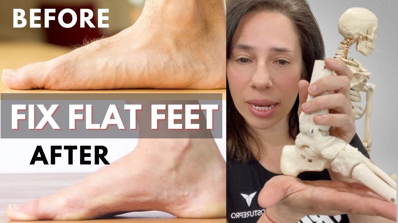 Flat Feet And The Effects On Posture How To Fix It 2021 Youtube