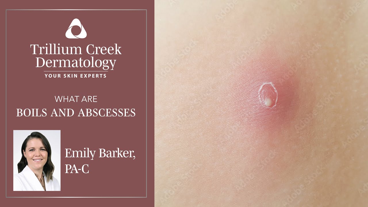What Are Boils And Abscesses Youtube