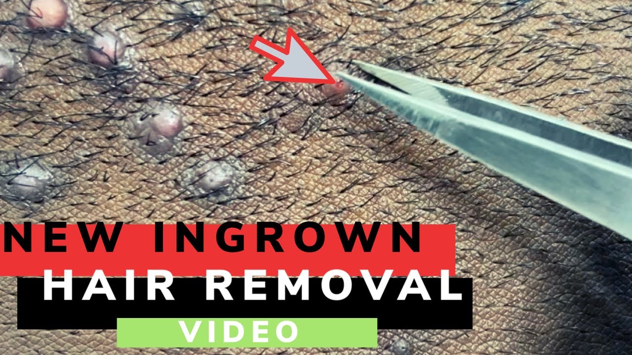 Beard Ingrown Hair Removal Pin On Beard Care Hanyatakankembali