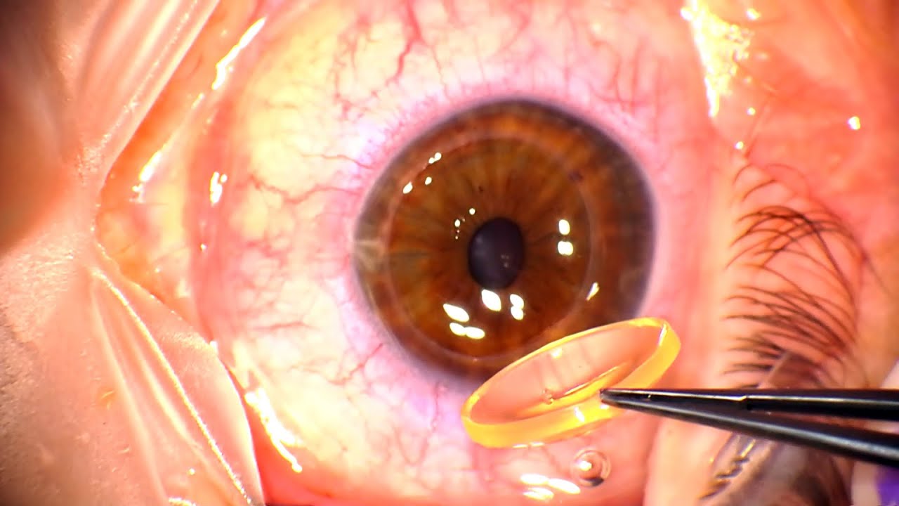 Corneal Transplant Penetrating Keratoplasty For Advanced Keratoconus