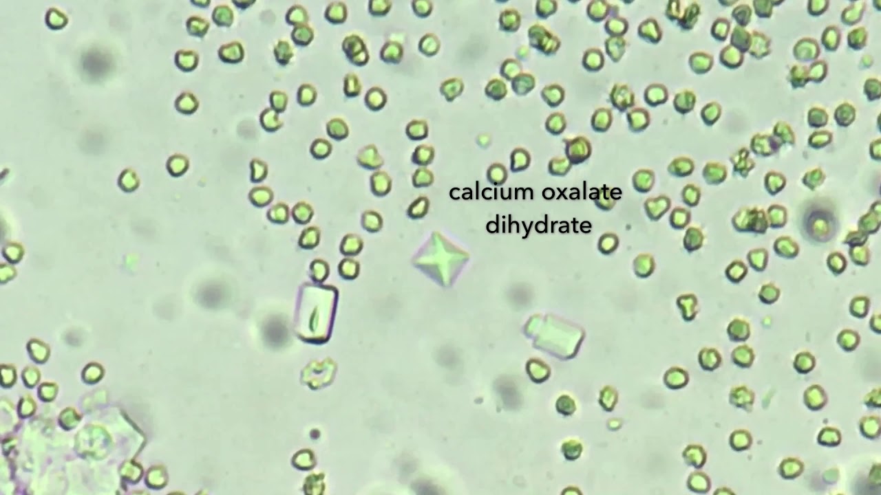 Calcium Oxalate Dihydrate Crystals In Urine