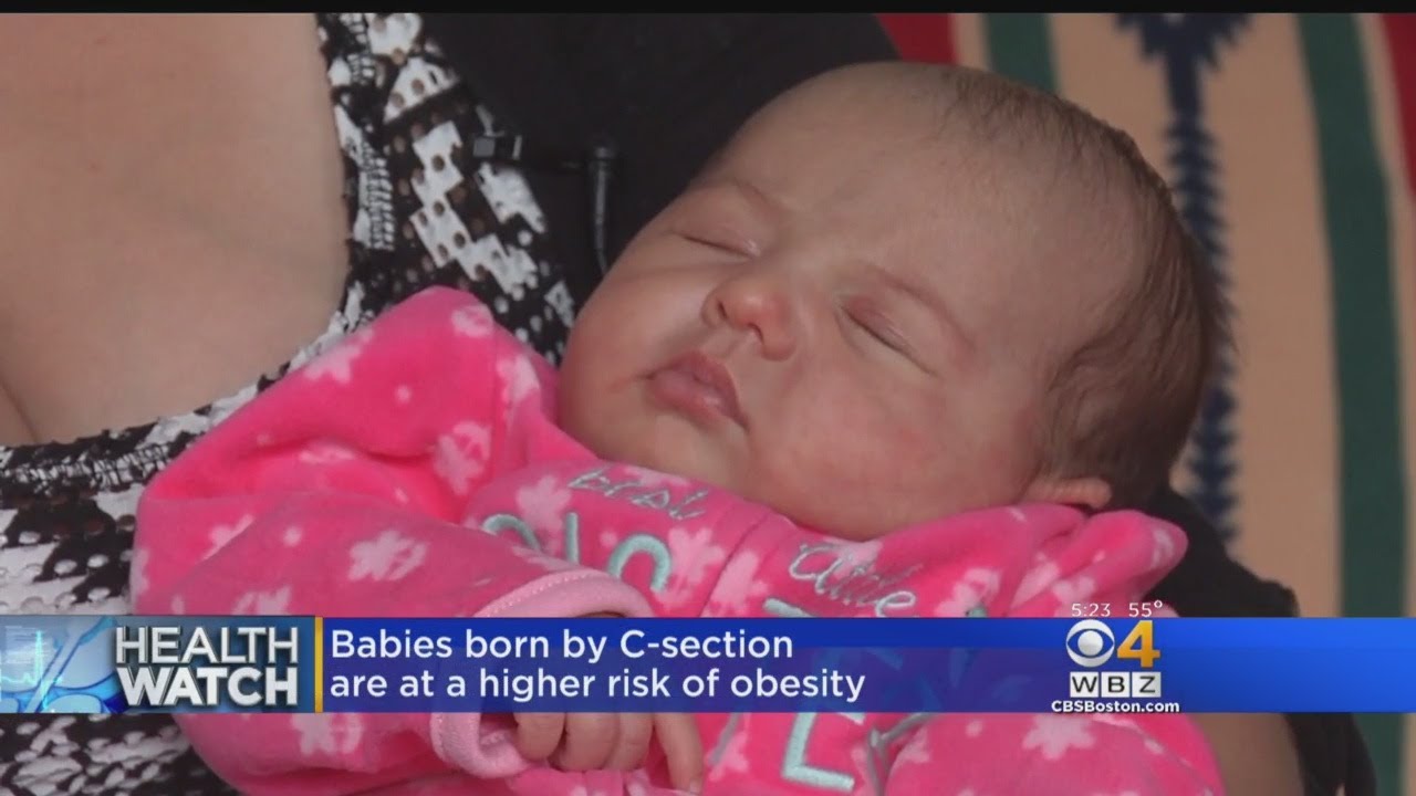 Healthwatch C Section Obesity Risk Baby Talk Same Around World Youtube