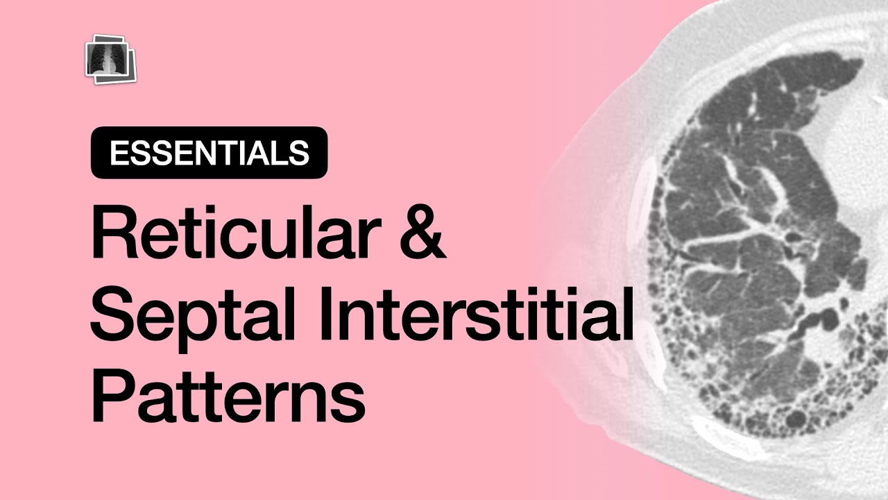 Reticular Septal Interstitial Patterns Chest Radiology Essentials