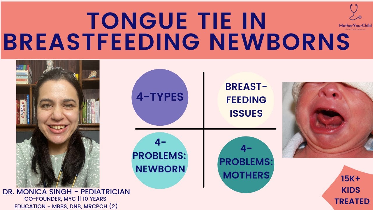 Tongue Tie Breastfeeding Journey At Harrison Fitch Blog