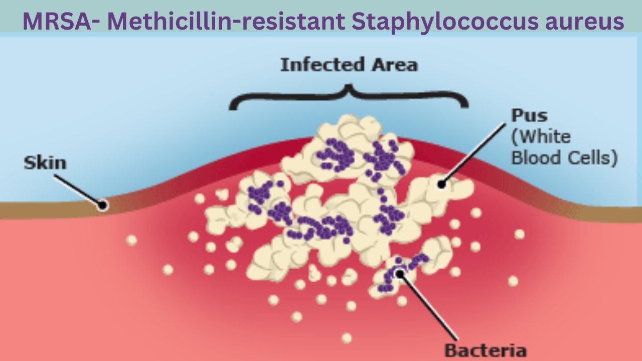What Is Mrsa Methicillin Resistant Staphylococcus Aureus Youtube