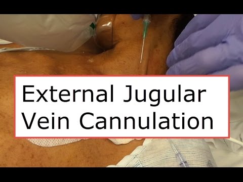 External Jugular Vein Cannulation