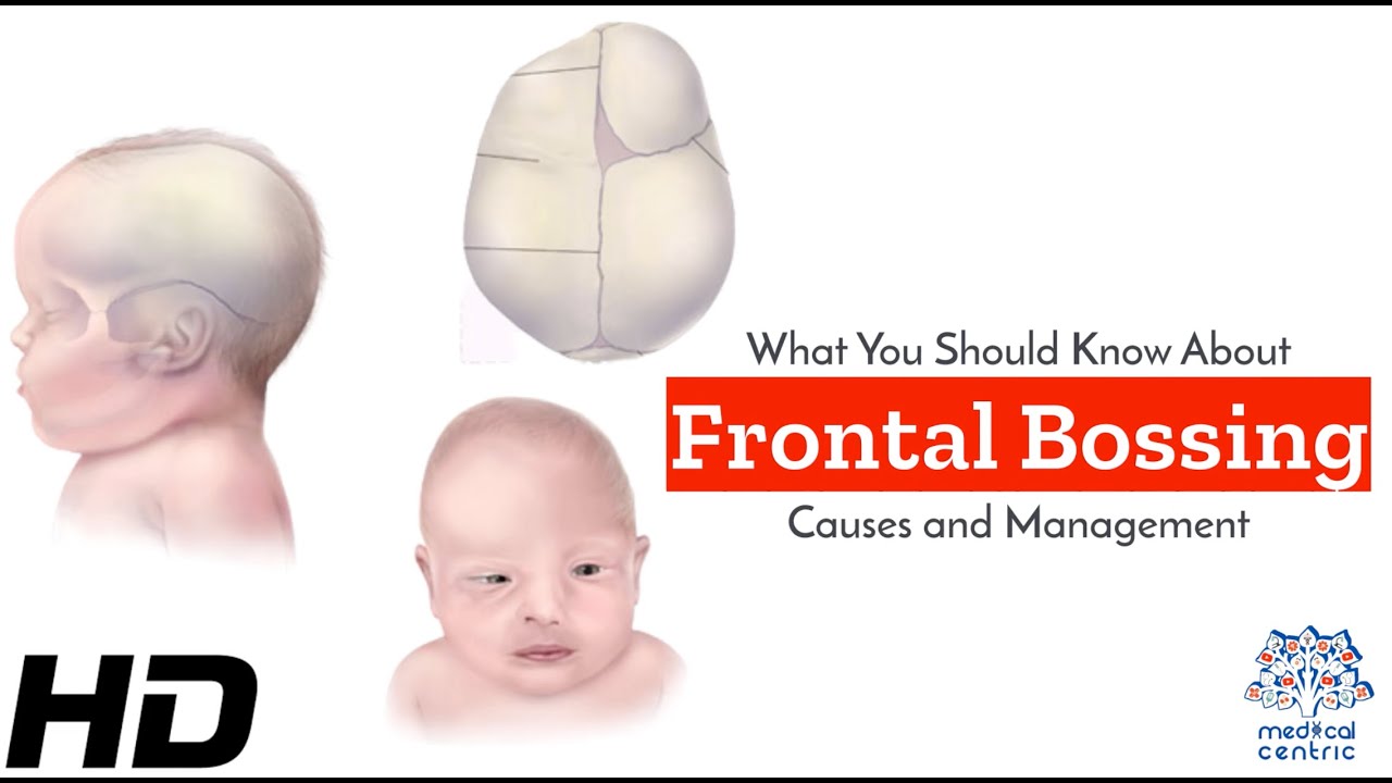 Unlocking Frontal Bossing Causes Management And What You Need To