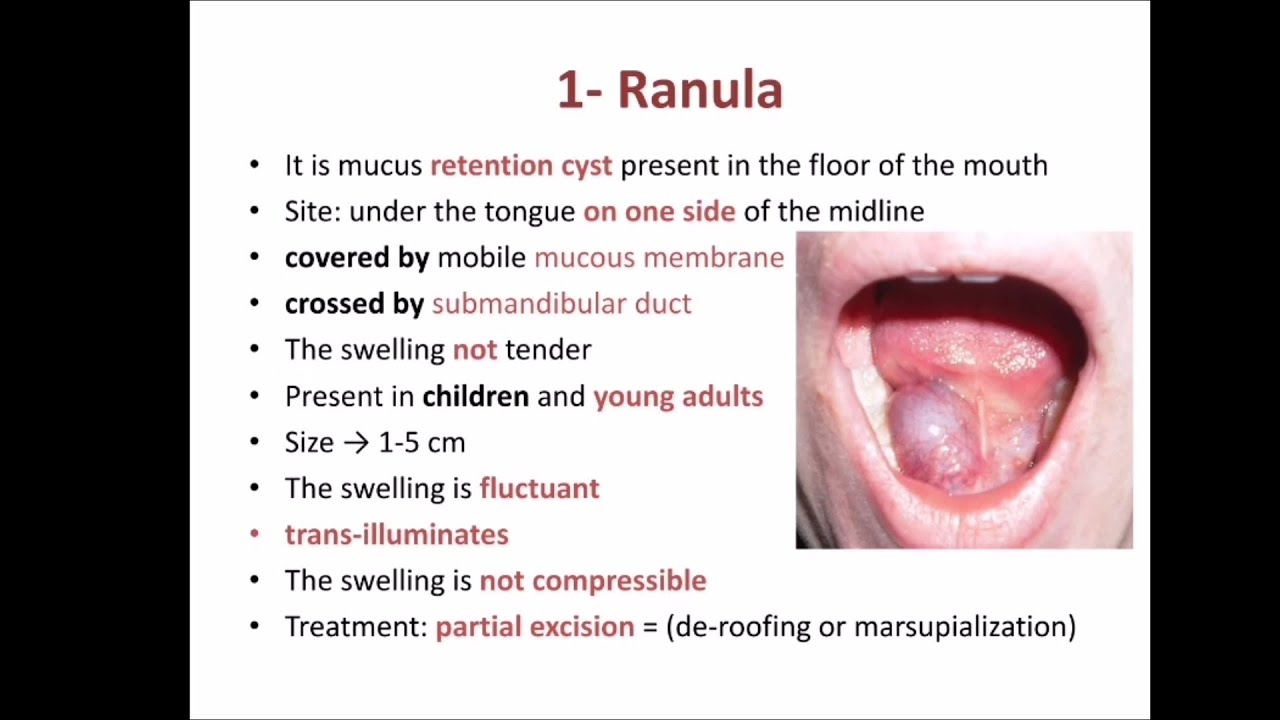 Cysts Of Floor Of Mouth Ranula And Sublingual Dermoid Cyst Youtube