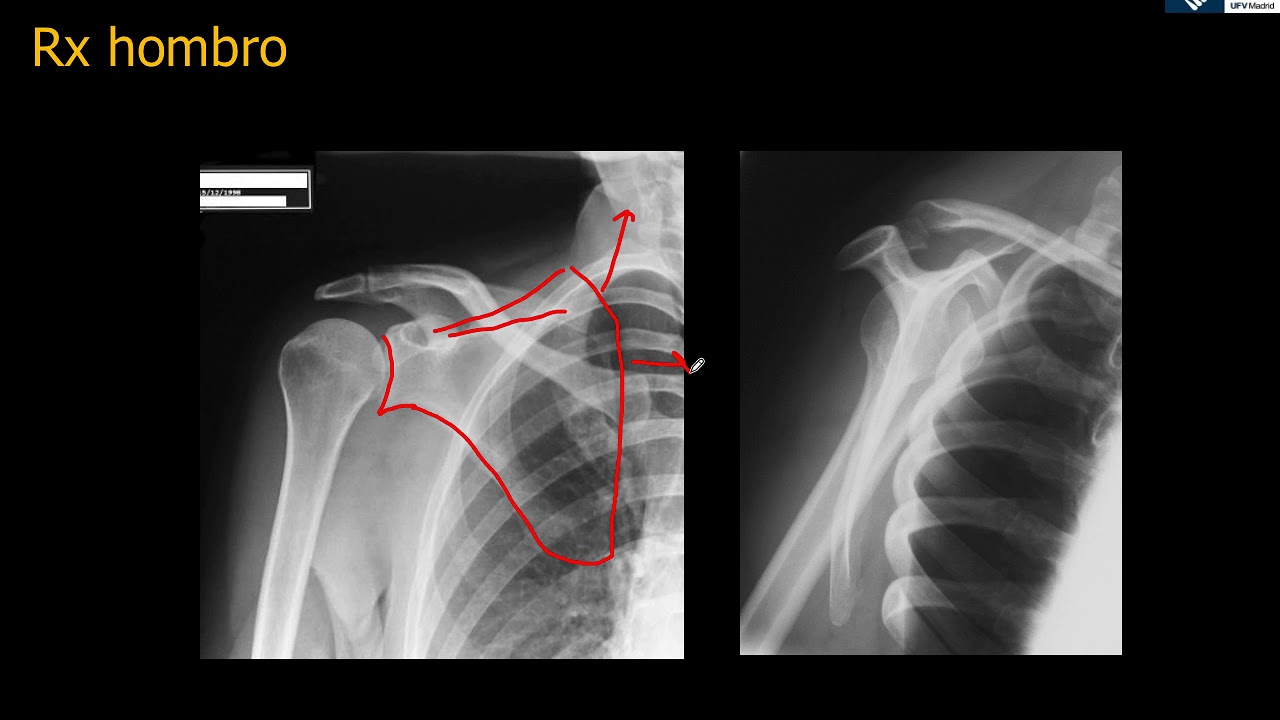 Anatomía Rx Hombro Youtube