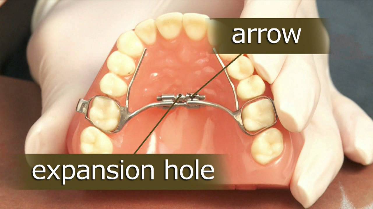 How To Turn Your Expander From Spillers Orthodontics Orthodontist