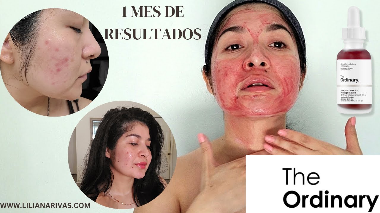 The Ordinary Aha 30 Bha 2 Peeling Solution Antes Y Despues Un Mes