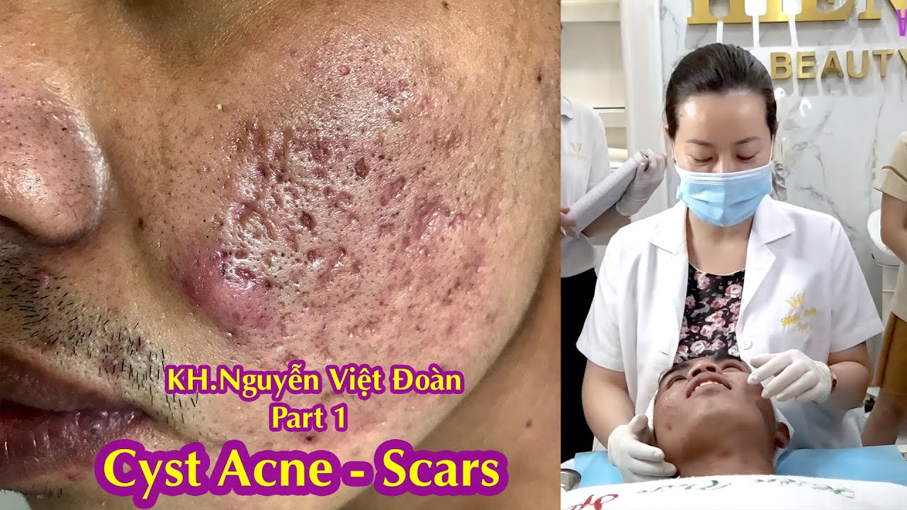 Cystic Acne Treatment I дђiб ѓu Trб Mб ґn Nang Hiб U Quбєј Sб 1 Tбєўi Hiб ѓn Vгўn
