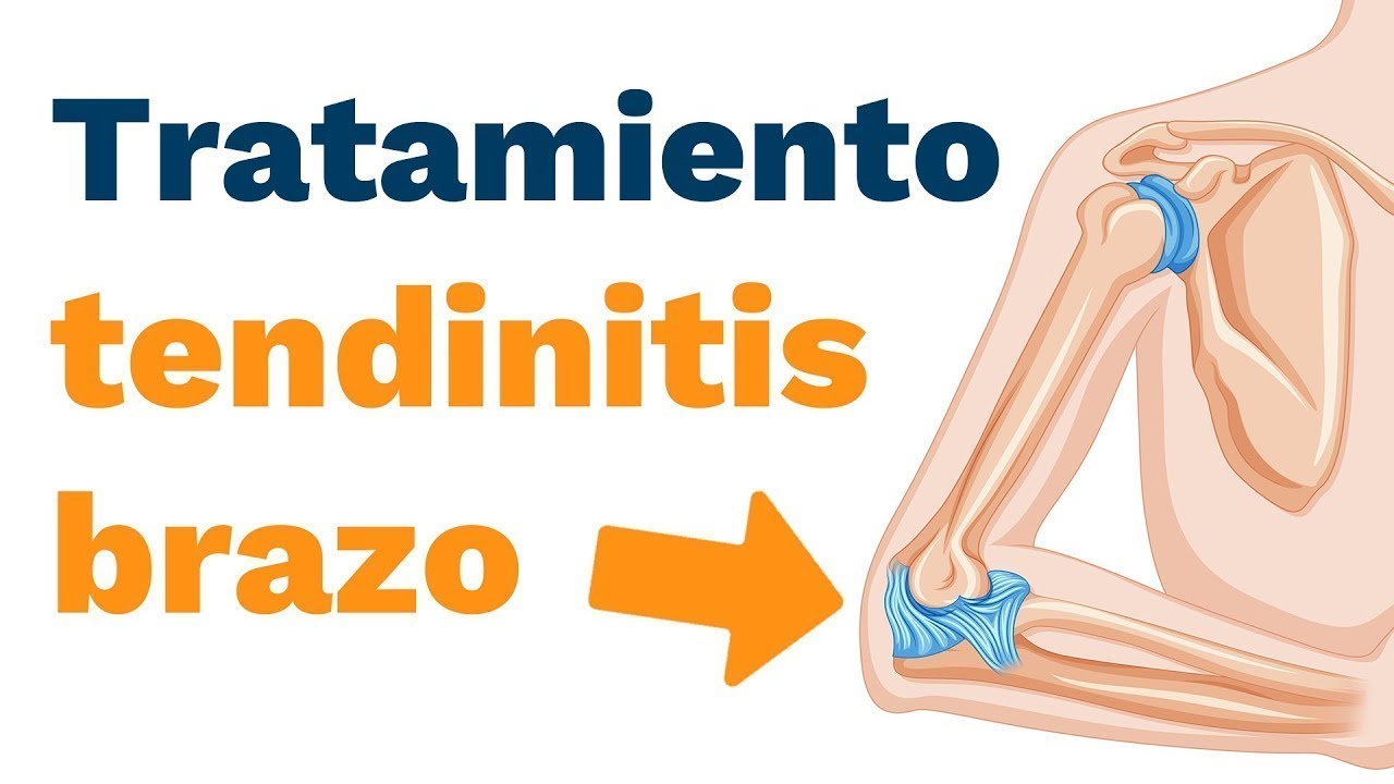 Cómo Tratar La Tendinitis En El Brazo Youtube