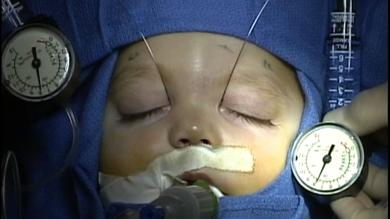Lacrimal Duct Obstruction Surgery