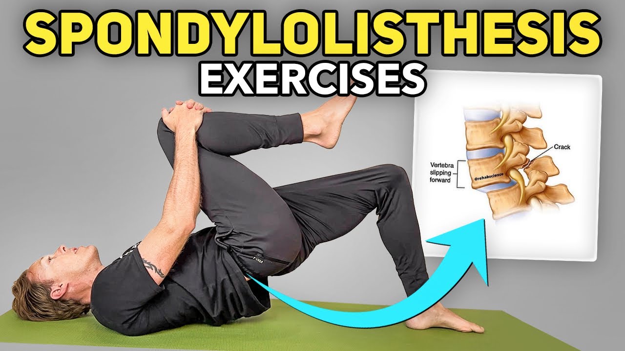 5 Exercises For Lumbar Spondylolisthesis Youtube