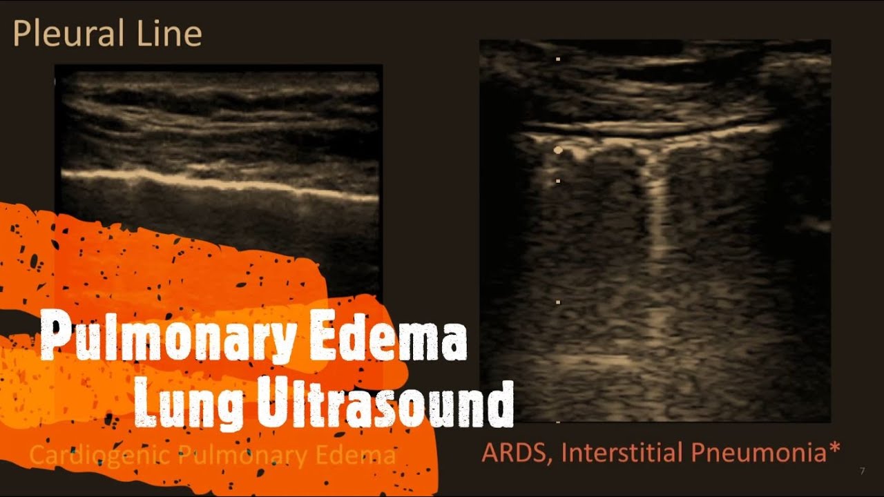 Pulmonary Edema On Lung Ultrasound Perioperative Critical Care Pocus