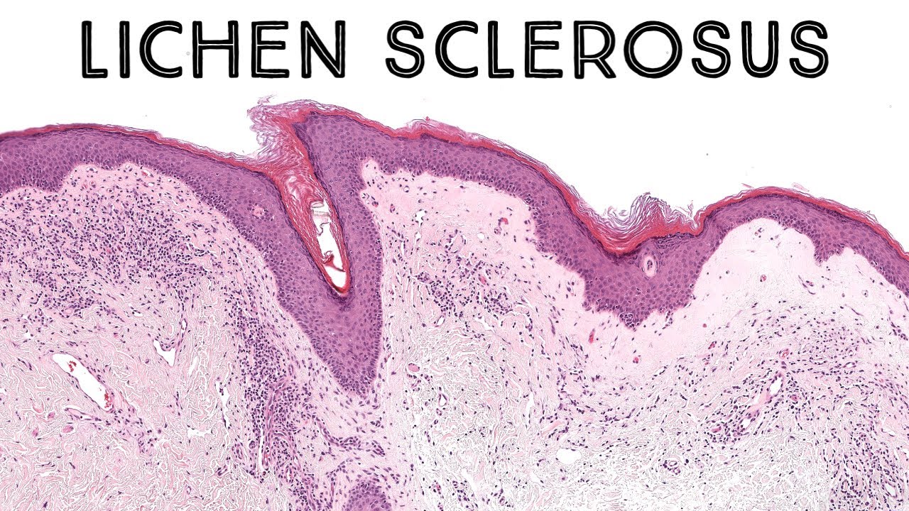 Quick Diagnosis Lichen Sclerosus Et Atrophicus Dr Sarma Pathology