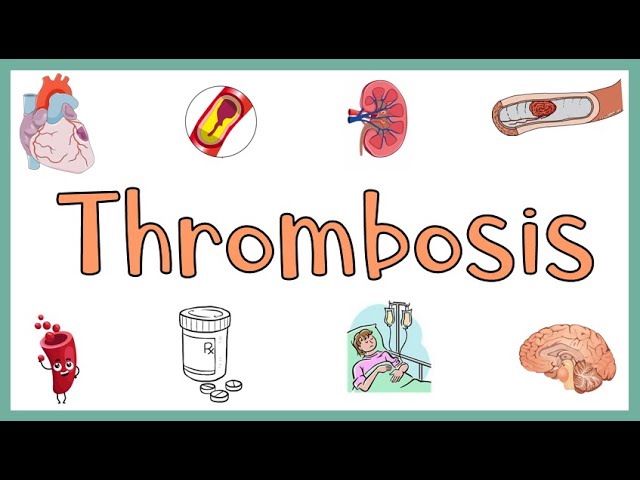 Thrombosis Vs Embolism Blood Clot Differences