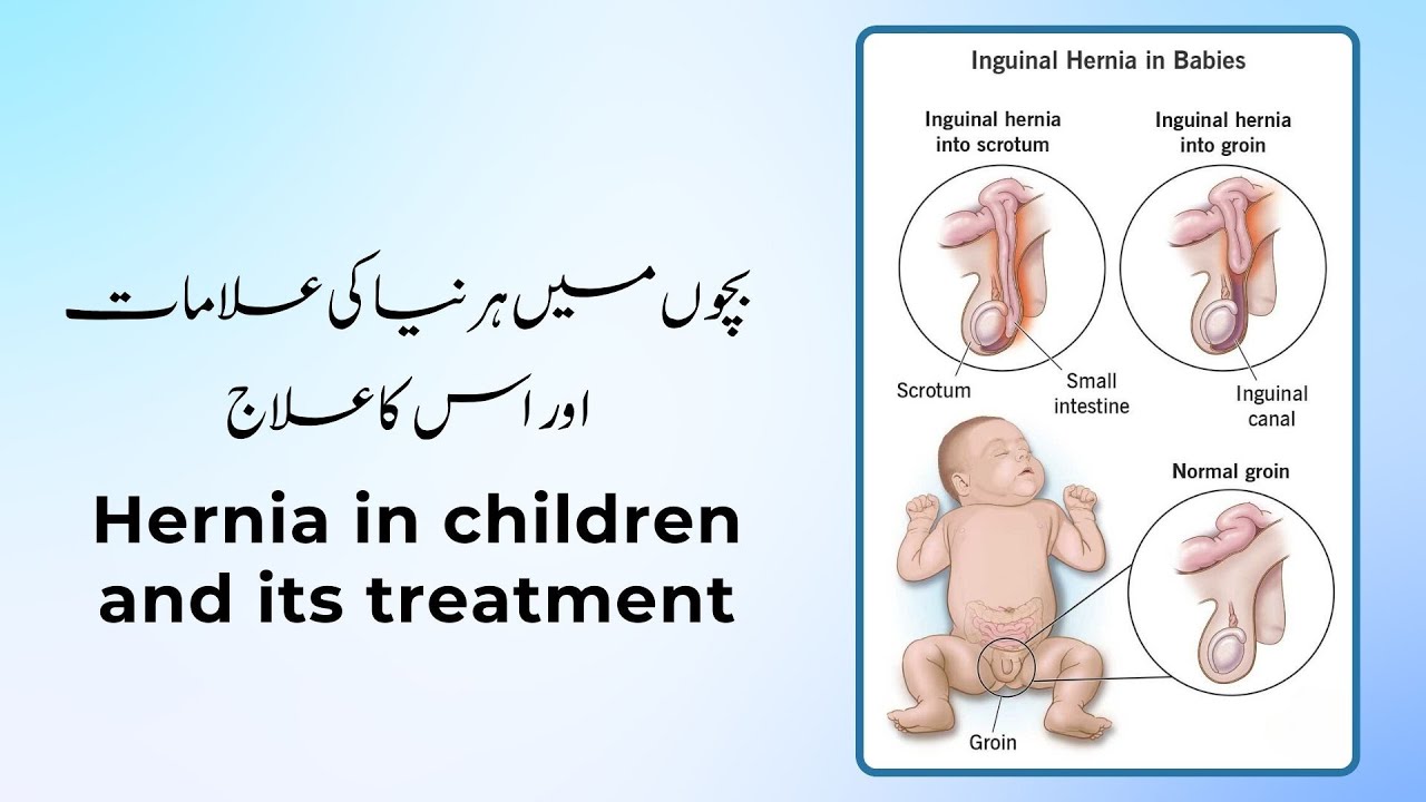 Inguinal Hernia Baby Uk