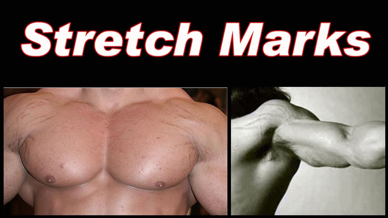 Bodybuilding Stretch Marks Youtube